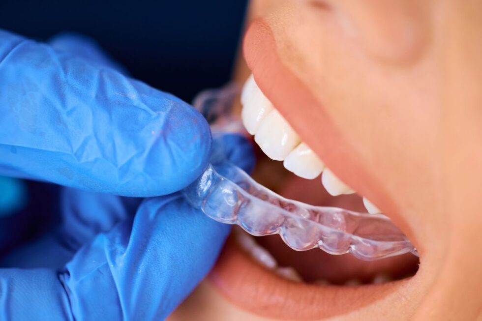 Can Invisalign Help Correct an Overbite?